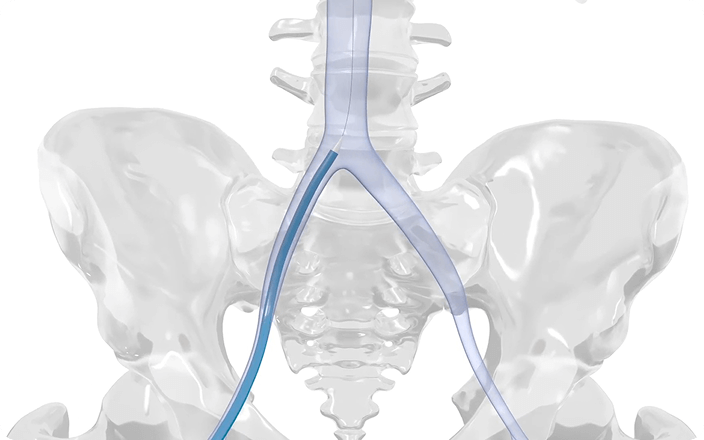 What is transcatheter edge-to-edge repair (TEER) | Edwards Lifesciences