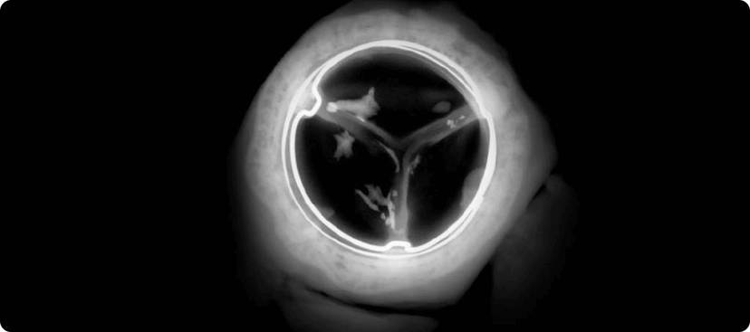 Transcatheter SAPIEN 3 Ultra RESILIA | Edwards Lifesciences