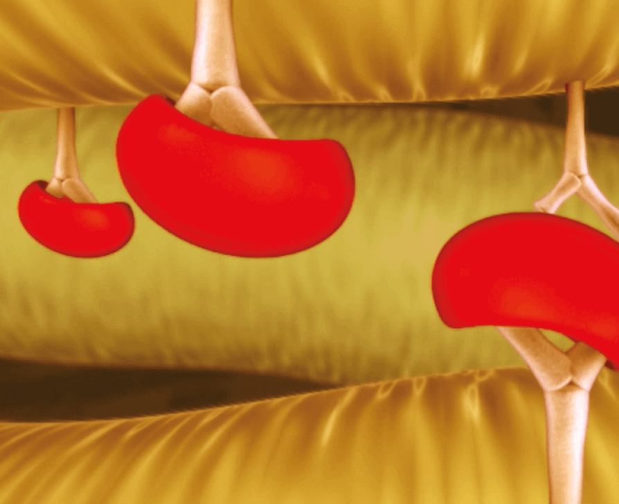 Transcatheter SAPIEN 3 Ultra RESILIA | Edwards Lifesciences