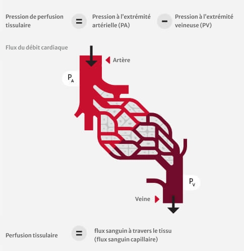 Gestion des fluides | Edwards Lifesciences
