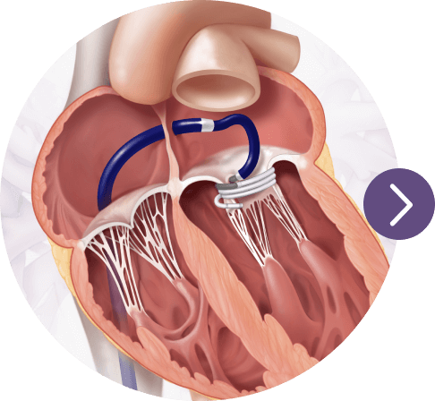 Sapien M3 | Edwards Lifesciences