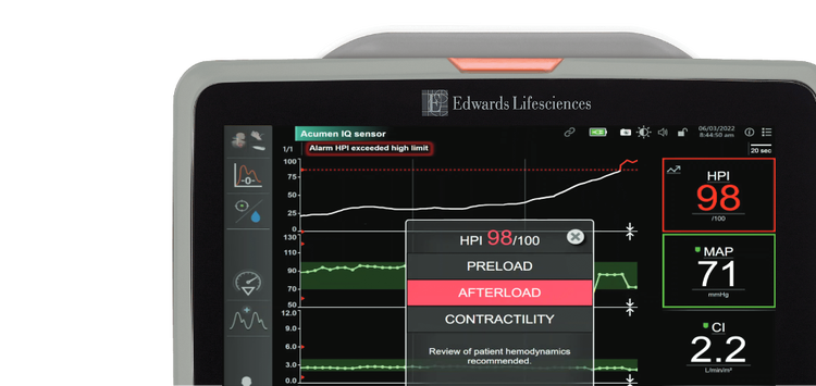 Acumen Hypotension Prediction Index software | Edwards Lifesciences