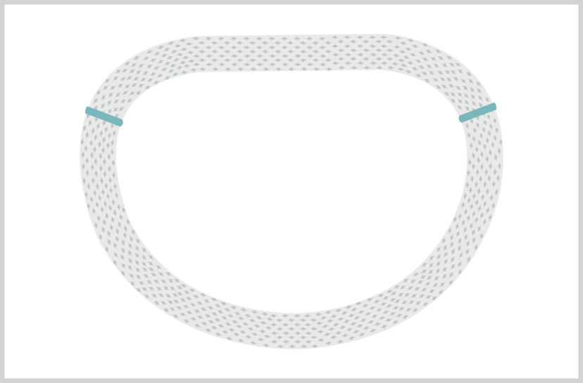Mitral Valve Repair | Edwards Lifesciences