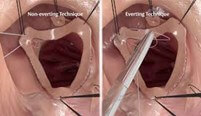 KONECT RESILIA Aortic Valved Conduit | Edwards Lifesciences