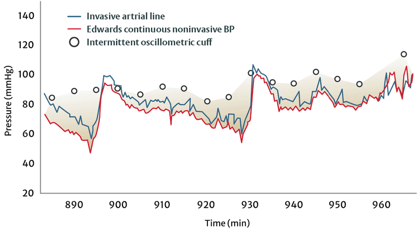 Acumen IQ cuff | Edwards Lifesciences