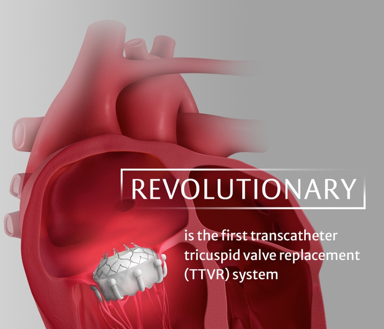 EVOQUE Tricuspid Valve Replacement | Edwards Lifesciences