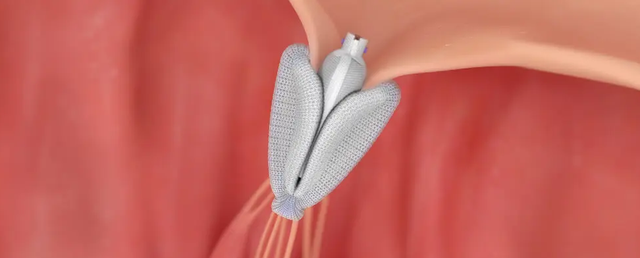 CLASP IID | Edwards Lifesciences