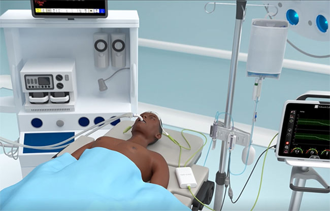 ForeSight tissue oximetry sensor | Edwards Lifesciences