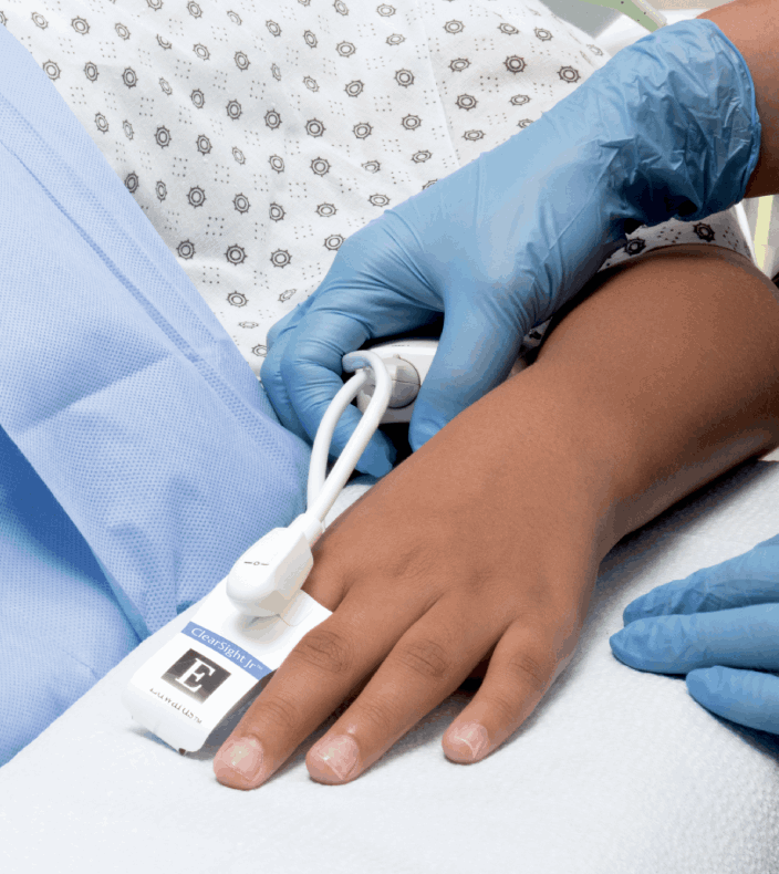 ClearSight Jr finger cuff | Edwards Lifesciences