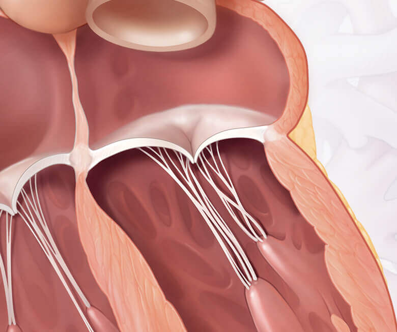 The CLASP IID/IIF Trial for Mitral Regurgitation | Edwards Lifesciences