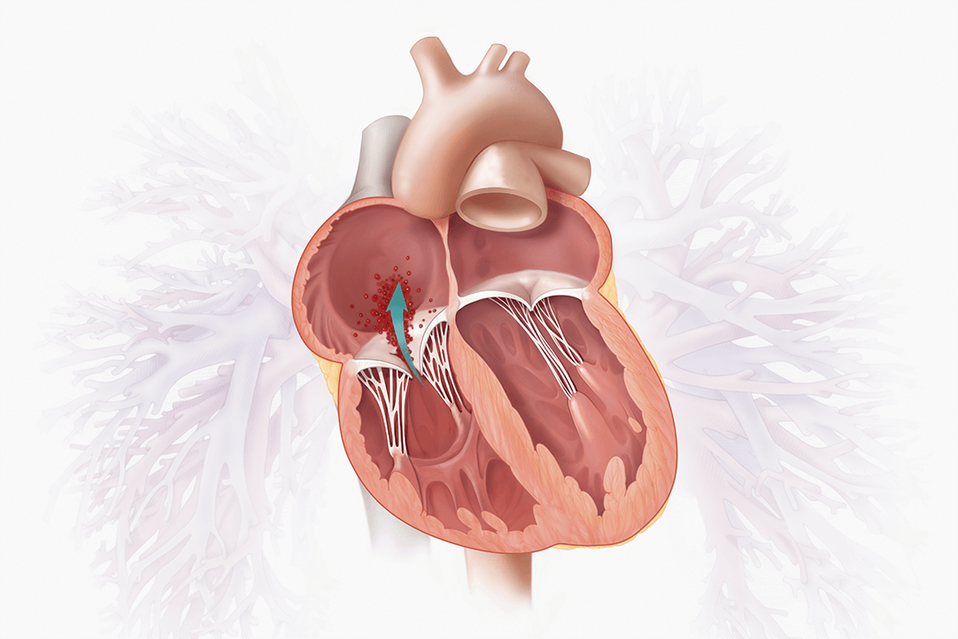 Severe tricuspid valve regurgitation and treatment | Edwards Lifesciences
