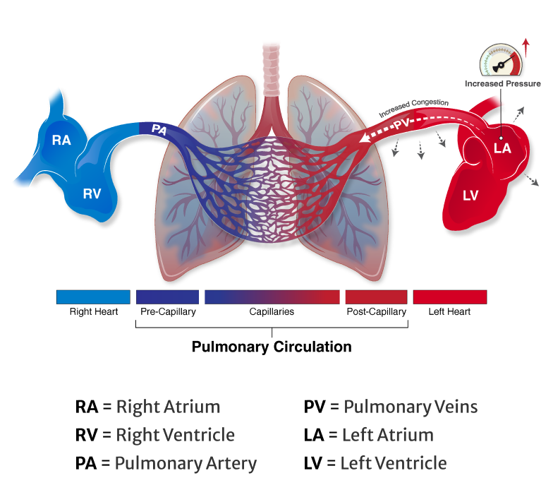 ALT-FLOW trial | Edwards Lifesciences