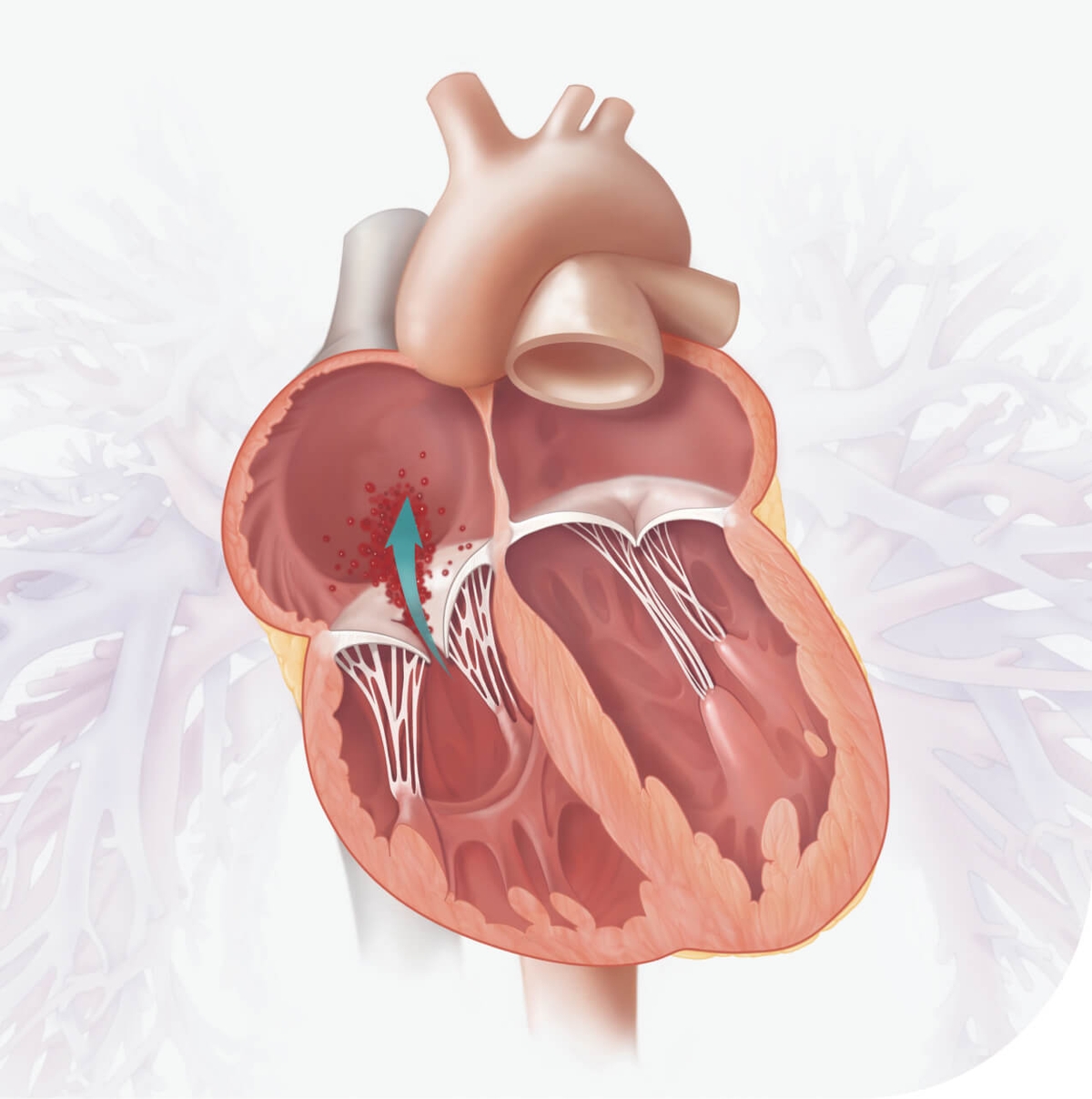 Learn about symptomatic severe tricuspid regurgitation and the options ...