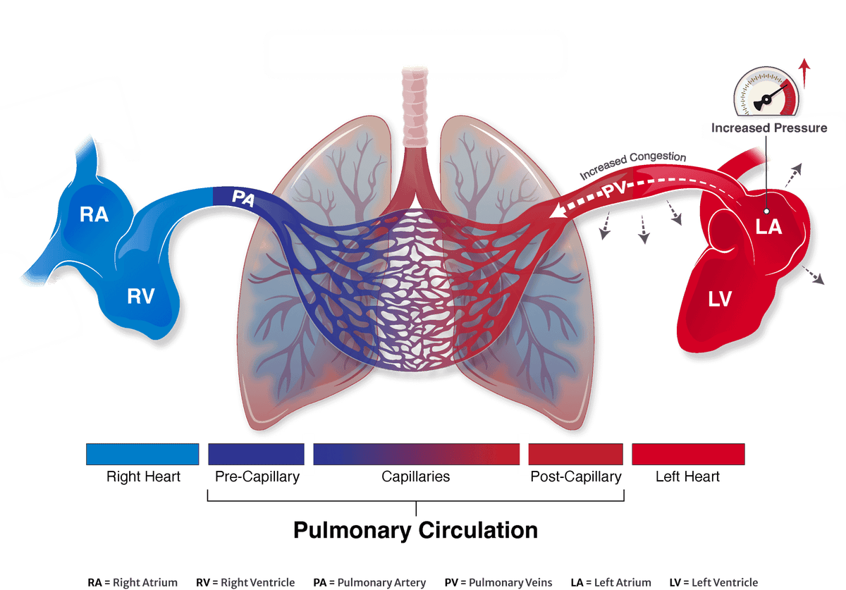 ALT-FLOW trial | Edwards Lifesciences