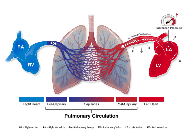 ALT-FLOW trial | Edwards Lifesciences