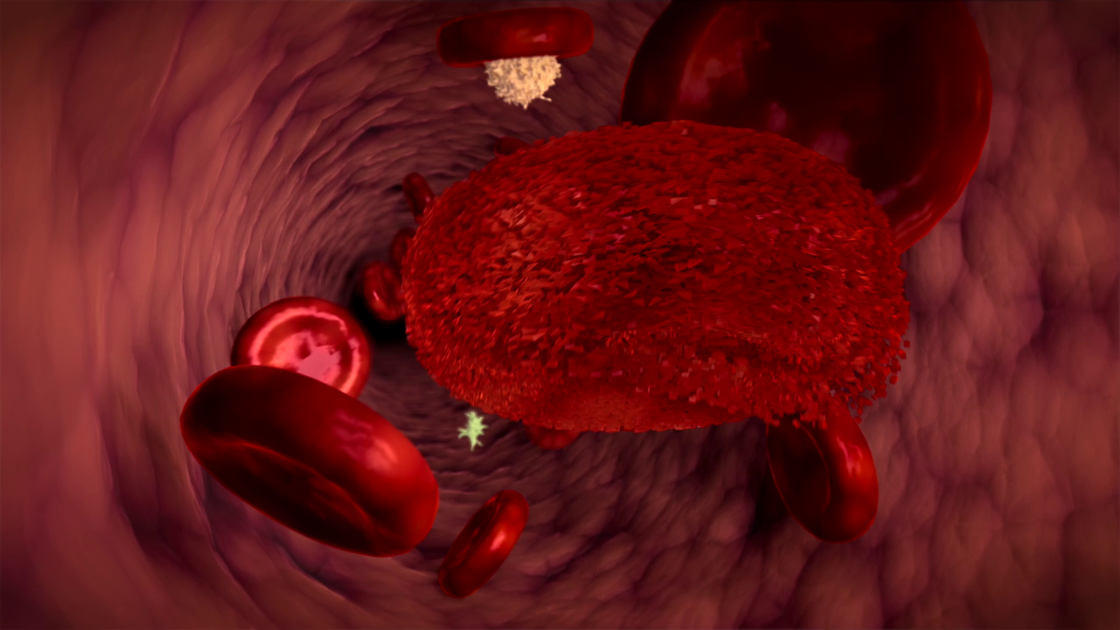 Blood Cancer | Diagnosis and Treatment Strategies with DKMS | DKMS