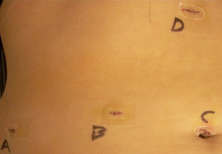 Near Infrared Therapy Wound Healing | Sunlighten